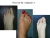 Monturi picioare - Hallux valgus. Operatie sau tratament?